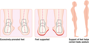 Find Out What Foot Pronation Is And How To Prevent Its Pain